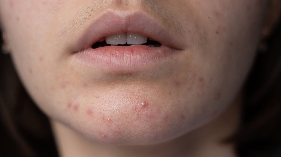 Vrste bubuljica: Evo kako ih prepoznati i liječiti - Lola Magazin